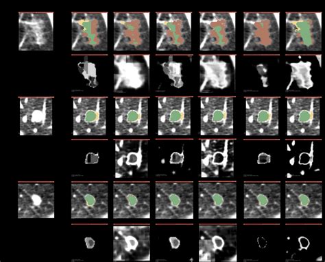 Segmentation Predictions Green True Positive Yellow False Positive