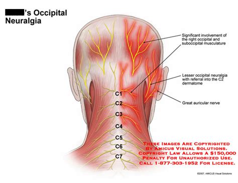 Occipital Neuralgia