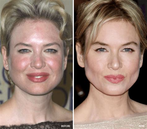 Celebrity Face Scars 60 Photos Moonagedaydreamfilm