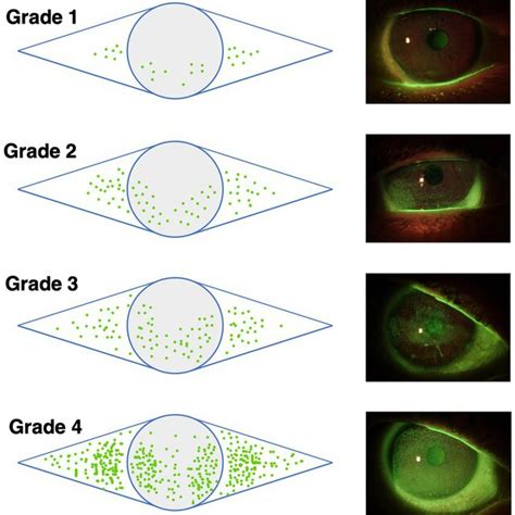 Findings In Ogvhd Conjunctival Hyperaemia And Corneal Staining A Download Scientific
