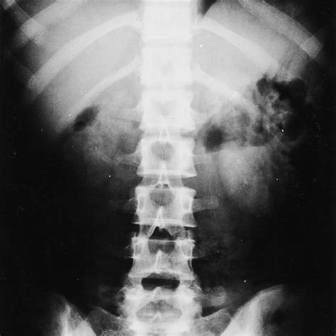 Plain Abdominal X Ray Taken At The Time Of Diagnosis Of Esrd