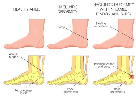 Haglunds Deformity Plantar Fascia Institute Of Mn