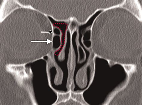 Failed Endoscopic Sinus Surgery Spectrum Of Ct Findings In The Frontal
