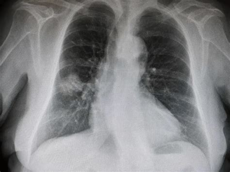 Absceso Pulmonar Dr Victor Zotes