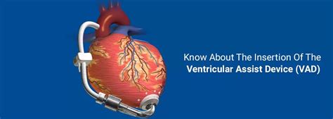 Ventricular Assist Device Vad Insights Bm Birla Hospital