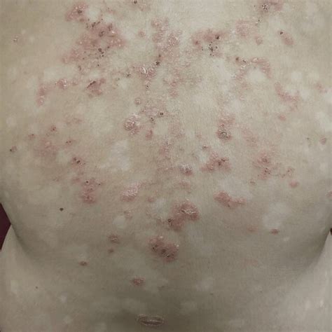 Pdf Rare Co Existent Dermatitis Herpetiformis And Psoriasis In A