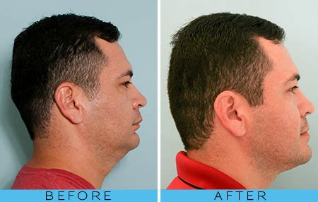 If Mma Surgery Has The Most Advancement Why Isnt It Noticeable