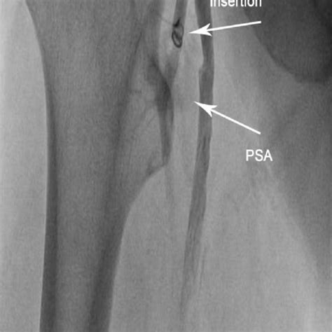 E Angiogram Showing Coil Insertion Following Thrombin Injection Into