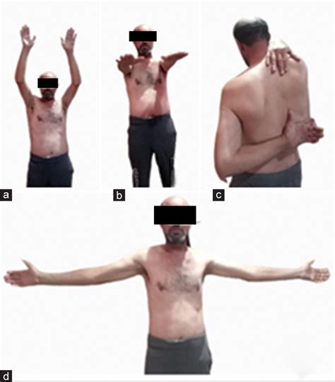 Is Reconstructing Anterior Sternoclavicular Joint Dislocation By A High