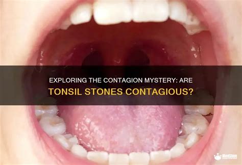 Exploring The Contagion Mystery Are Tonsil Stones Contagious Medshun