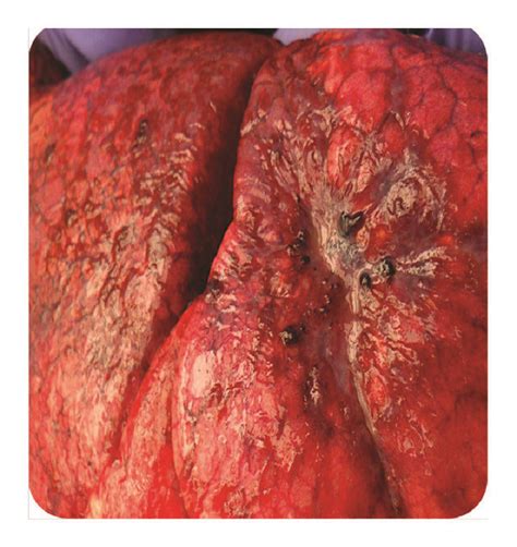 Postmortem Finding Hepatization Of The Lung Download Scientific Diagram