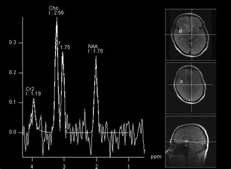 Mr Conditional Pacemaker Systems Also Enable Nmr Spectroscopic Studies