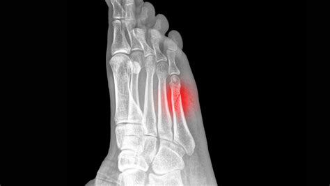 What Is A Stress Fracture And How To Avoid It Vitalis Physiotherapy