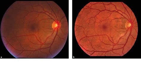 Figure 1 From Computer Assisted Microaneurysm Turnover In The Early