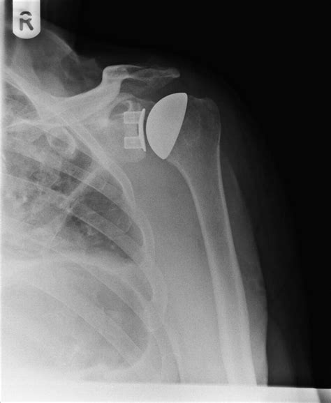 Shoulder Arthroplasty Part 2 Normal And Abnormal Radiographic