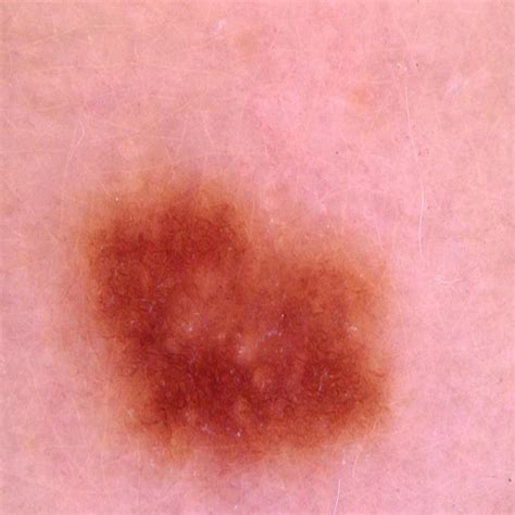 Skin Cancer Object Detection Object Detection Dataset V1 2024 03 24 11 15pm By Lp