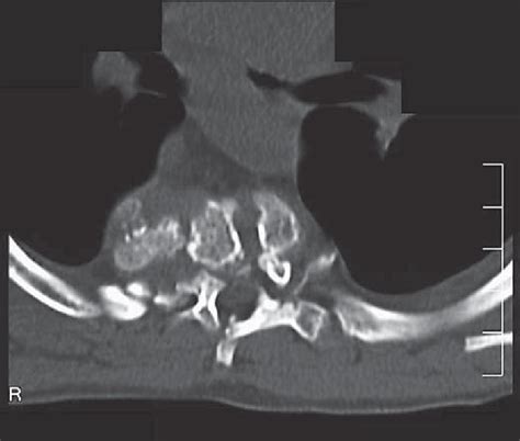 Spinal Ct At The Age Of 13 Years Showing Asymmetric Ossifications Of