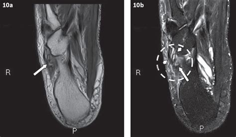 Os Peroneum