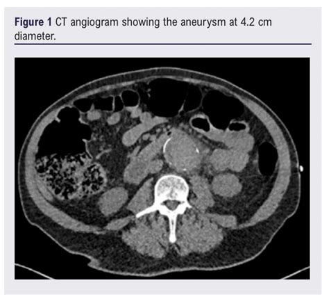 The First Confirmed Isolation Of Dermabacter Vaginalis From A Mycotic Abdominal Aortic Aneurysm