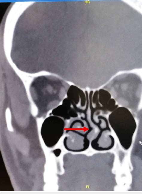 Ct Pns Showed Extreme Right Septal Deviation Ct Pns Ct Scan Of Download Scientific Diagram