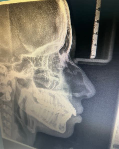 انا سويت اشعه للاسنان عشان اركب تقويم هل يتطلب خلع الضواحك الطبي