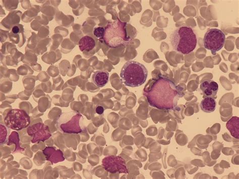 Cytoplasmic Vacuolation Nuclear Budding