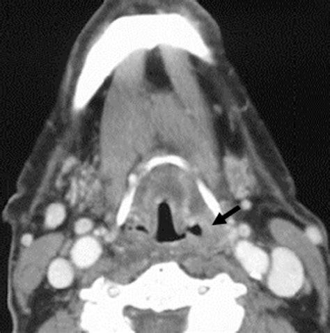 Pharynx And Esophagus Clinical Tree