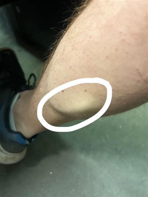 Soft Lump In Right Calf Only When I Flex It R Medical Advice