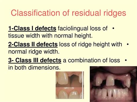 Ppt Understanding Pontics In Fixed Dental Prosthesis Powerpoint