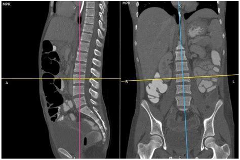Ossification And Fusion Of The Vertebral Ring Apophysis As An Important
