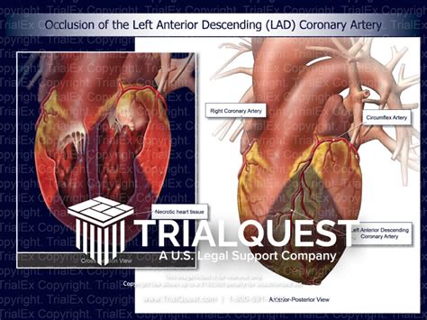Left Anterior Descending Artery Causes Bkehxx