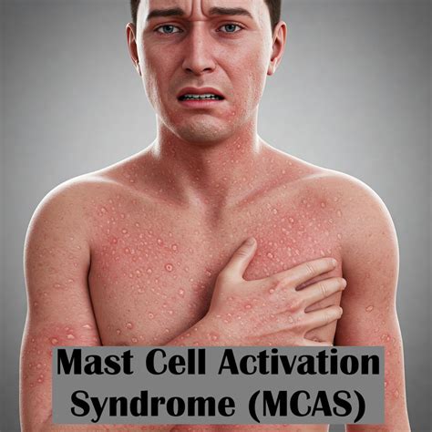 What Is Mast Cell Activation Syndrome Mcas The Immune System Gone Rogue