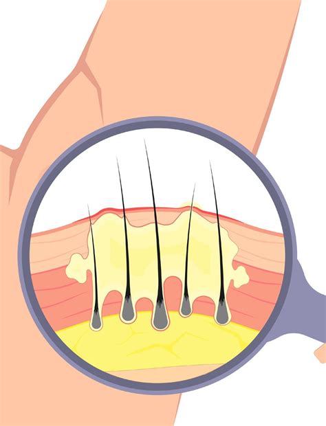 Ucbs Sbla For Bimzelx Accepted By Fda For Hs Treatment