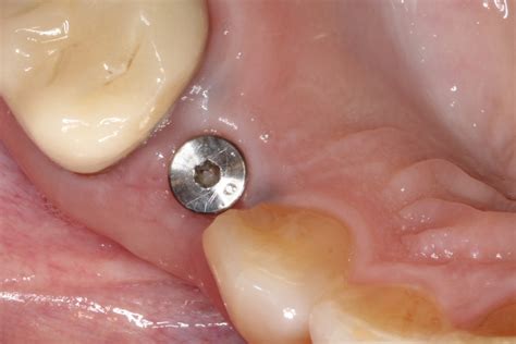 Osteogen Plugs The One Step Bone Graft Solution For Socket Preservation