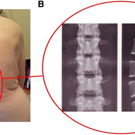 Radiographic Image Of A Normal Spine Spinous Process S Lamina L Download Scientific
