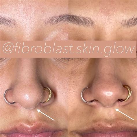 Fibroblast Nose Job How Its Done And Does It Work Nose Job Nose