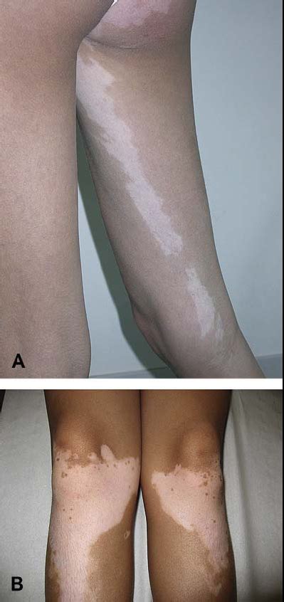 What Is Segmental And Non Segmental Vitiligo • Vitiligo Cover
