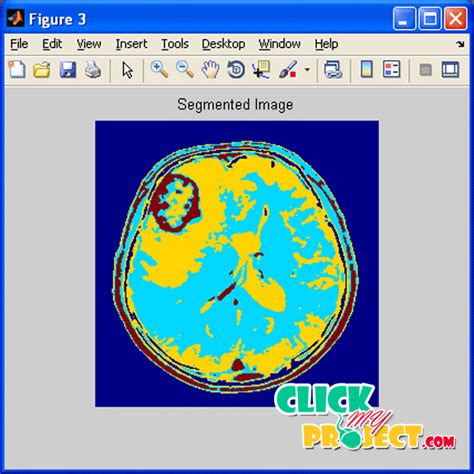 Mri Brain Classification Using Support Vector Machine Clickmyproject