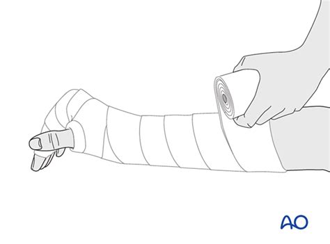 Application Of A Dorsal Splint