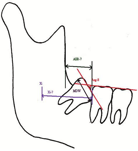 Retromolar Area