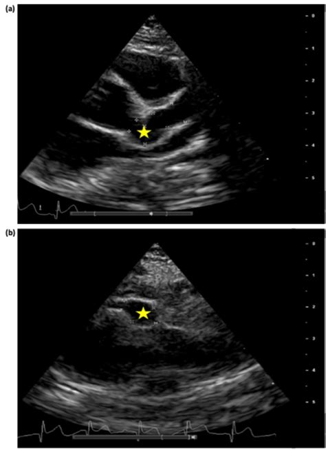 Echocardiogram Performed On Day 57 Of Illness Parasternal Short Axis Download Scientific