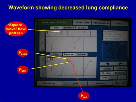 Ppt Ventilator Waveforms Basic Interpretation And Analysis