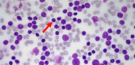 Solved These Malignant Cells Seem To Have Mixed Morphology