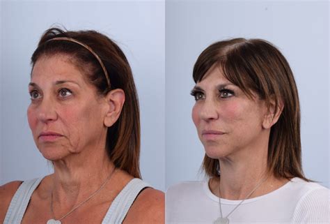 Plastic Surgery Jowls Before After Pictures Female