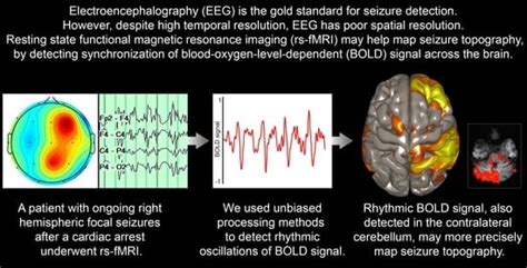 Ictal Fmri Mapping Seizure Topography With Rhythmic Bold Oscillations