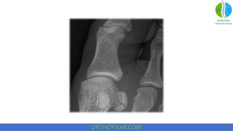 Sesamoid Fracture Broken Sesamoid Orthofixar
