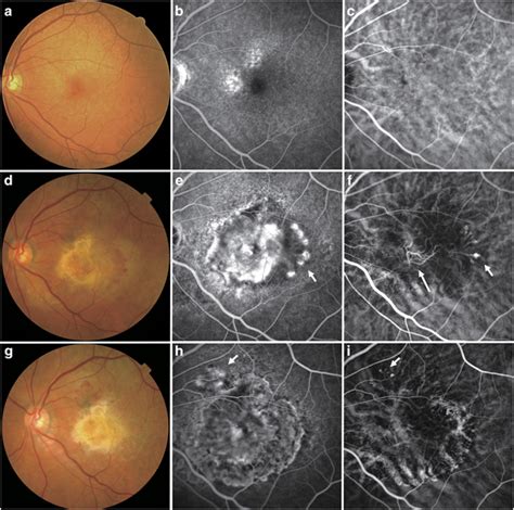 Development Of Polypoidal Lesions At The Terminus Of Newly Progressed Download Scientific