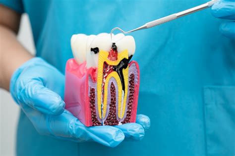 Post Root Canal Recovery Tips