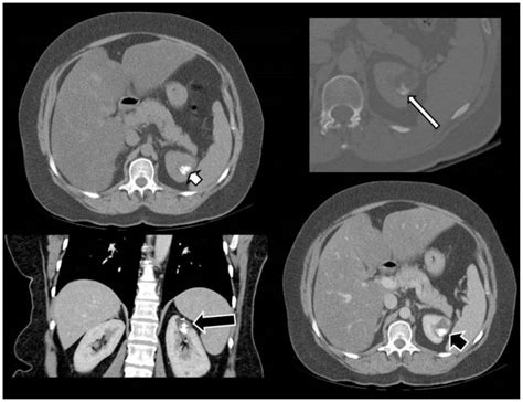Calyceal Diverticulum A Mimic Of Different Pathologies On Multiple