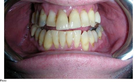 Upper Hybrid Prosthesis Before And After Photos Manchester Nh